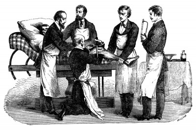 A History of Orthopaedic Amputations